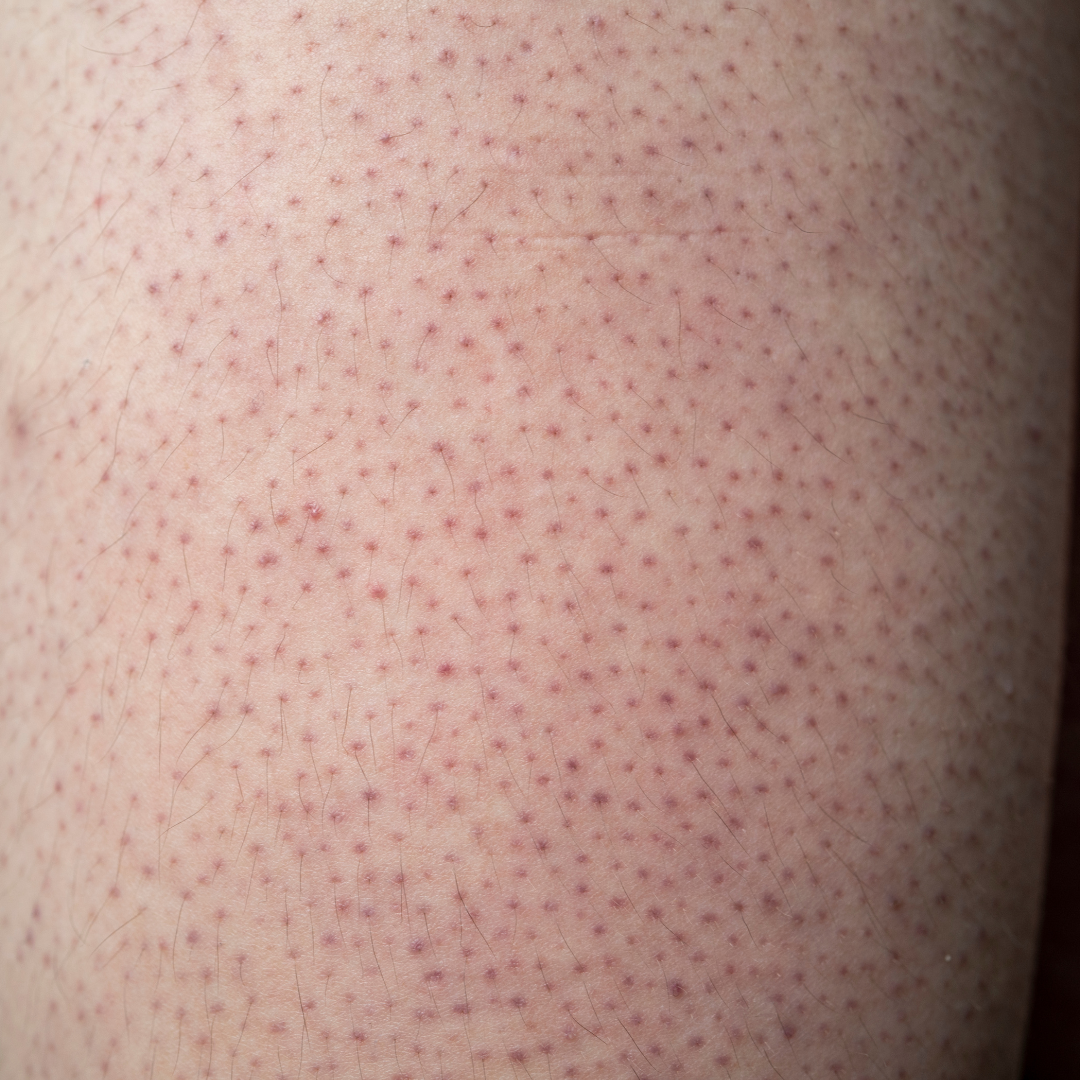 Keratosis Pilaris Natural Remedy Veenourish