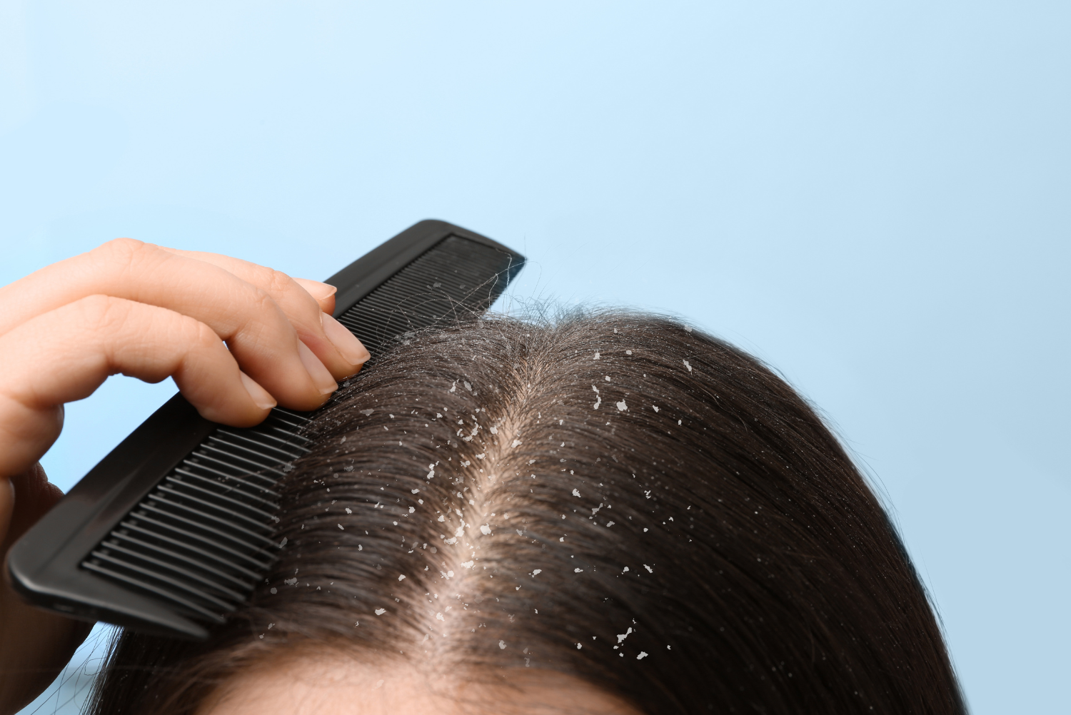 How to Get Rid of Dandruff: Effective Treatments and Tips – Veenourish